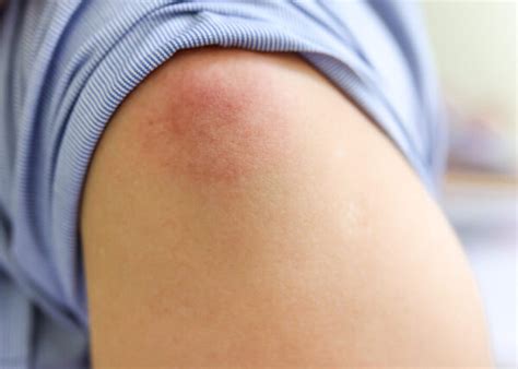 Cellulitis Treatment Dermatology Inc