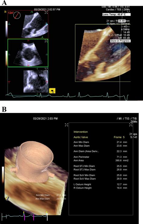 4d Tee Aortic Root Measurements A Acquired 3d Data Set With Selected Download Scientific