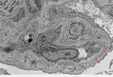 Electron Microscopy Demonstrates One Capillary Loop With Duplicated Download Scientific Diagram