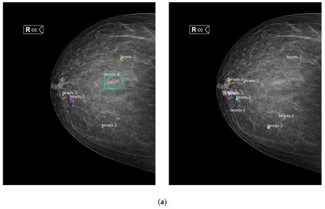 Two Stage Deep Learning Method For Breast Cancer Detection Using High Resolution Mammogram Images