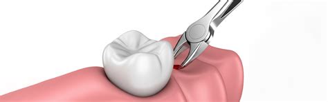 How To Stop Dry Socket After A Tooth Extraction Treatment