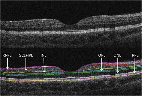 normal macula oct