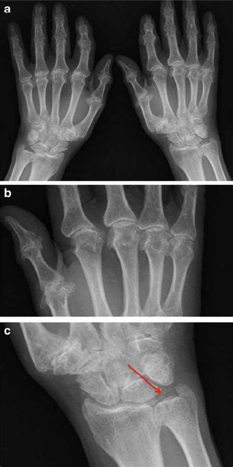 Hemochromatosis Arthropathy Conventional X Ray Of The Hands Showing