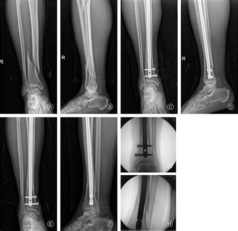 Distal Tibia Fracture