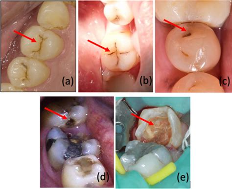 Tooth Surfaces With Icdas Scores A Oa B 03 C 04 D 05 And E 06 As