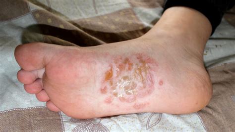Dyshidrotic Eczema Dyshidrosis Um Health Sparrow