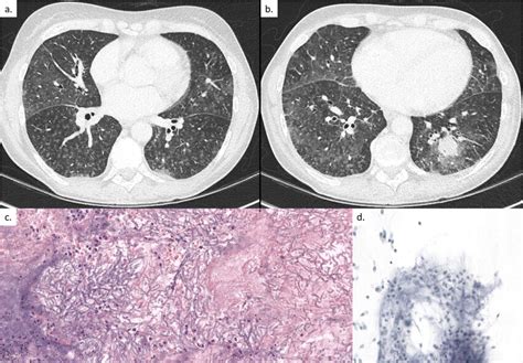 A Pulmonary Computed Tomography CT On Day 12 Showing Diffuse Download Scientific Diagram