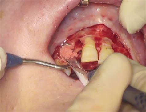 Zygoma Plus New Technique Part 1 Dr Alex Aesthetic