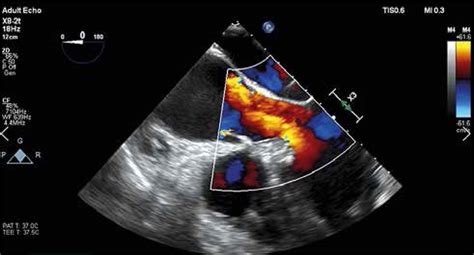Mini David Procedure Procedural Considerations
