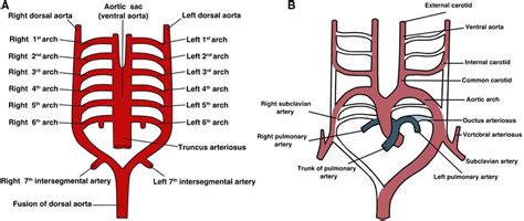 Frontiers Persistent Fifth Aortic Arch A Comprehensive Literature Review