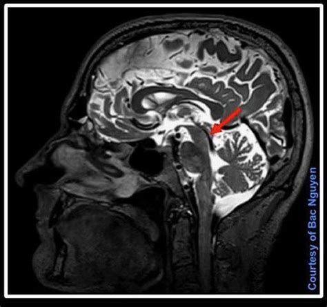 An Easy Technique To Confirm CSF Flow Within Aqueduct MEDizzy