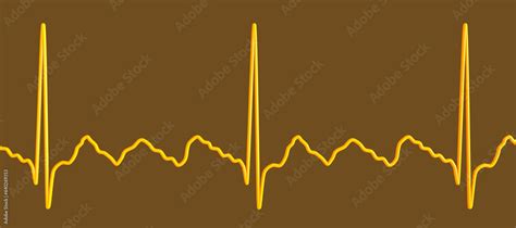 ECG In Atrial Flutter D Illustration Stock Illustration Adobe Stock