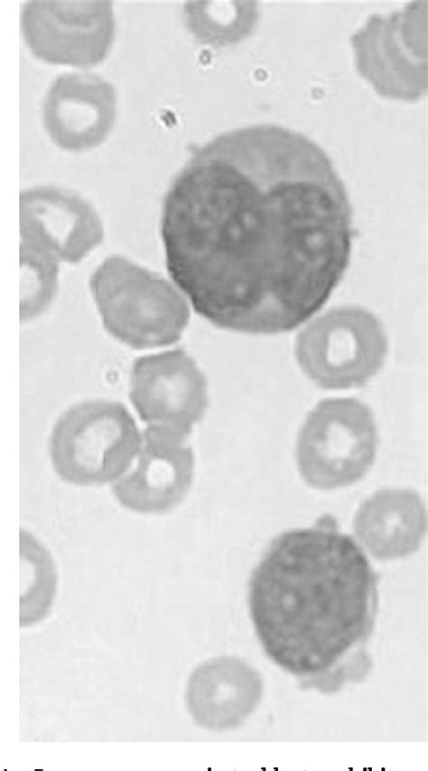 [pdf] Report Cell Myeloid Mixed Phenotype Acute Leukemia Ith Monocytic Differentiation And