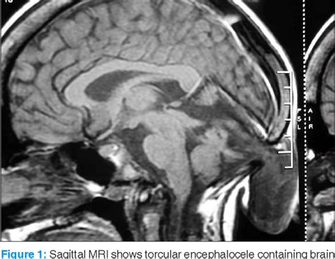 Figure 1 From A Torcular Encephalocele With Proatlas Defect And Os Terminale Semantic Scholar