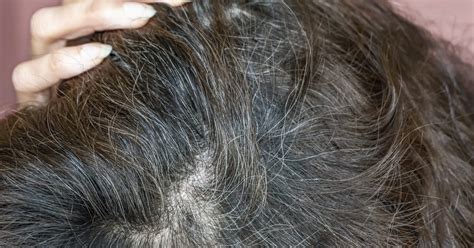 7 Foods And Habits That Can Make You Go Prematurely Gray According To