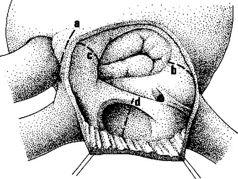 Figure 1 From Temporary Loss Of Cardiac Autonomic Innervation After The Maze Procedure