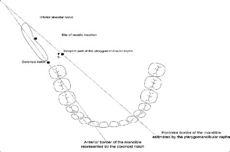 Inferior Alveolar Nerve Block Anatomical Landmarks Vr