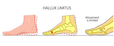 Hallux Rigidus Right Foot