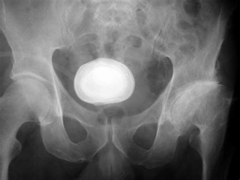 Bladder Calculus Large Radiology Case Radiology Calculus Bladder