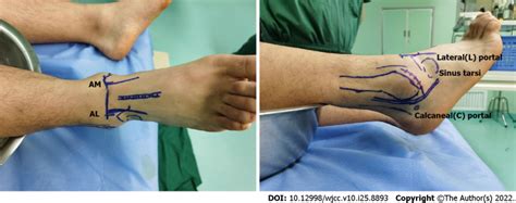 Arthroscopic Anatomical Reconstruction Of Lateral Collateral Ligaments
