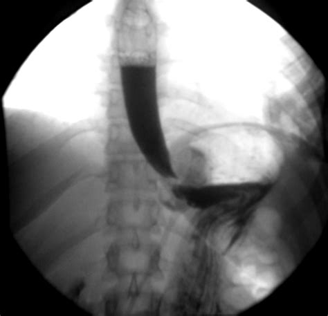 Gastric Band Assessment Radiology At Ruben Ramos Blog