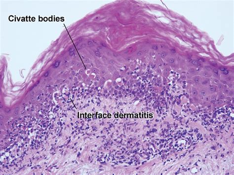 Interface Dermatitis Clinical Tree
