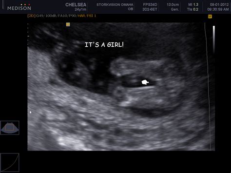 Fetal Sex On Ultrasound Tinyteens Pics