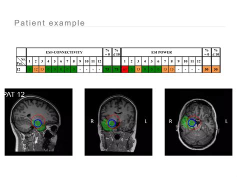 Ictal Eeg Source Imaging Pptx Brain And Nervous System Disorders Diseases And Conditions