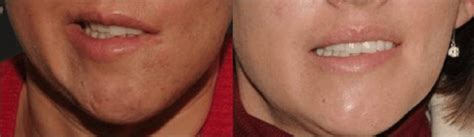 Results 4 Months After Masseter Nerve Transfer Download Scientific