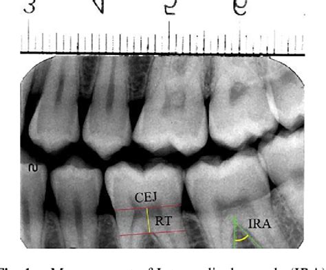 Figure 2 From Assessing Peculiarity Of Molar Root Trunk Dimensions In A
