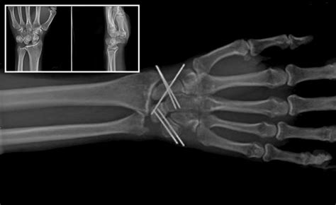 Dislocation Wrist Perilunate Hand Surgery Resource