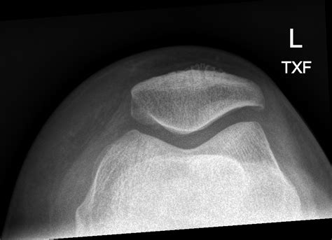 Chondromalacia Patella X Ray At Cody Caron Blog