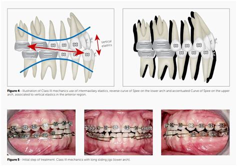Pdf Vertical Control In The Class Iii Compensatory Treatment