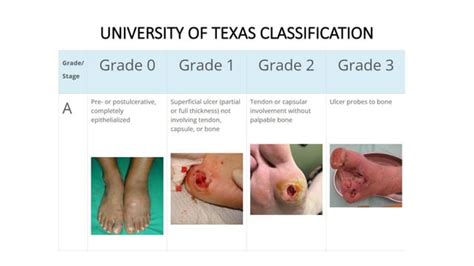 Diabetic Foot Ulcer Classification System Texa S And Wagnerpptx