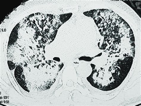 Thoracic Computed Tomography Showing Diffuse Alveolar Infiltrates Download Scientific Diagram
