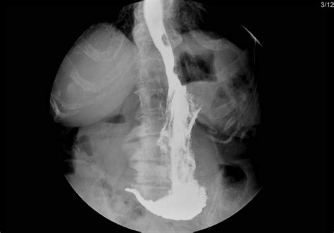 Upper Gi Fluoroscopy To Assess The Results Of The Hernia Repair During Download Scientific