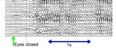 Week 3 Electroencephalography Eeg Flashcards Quizlet