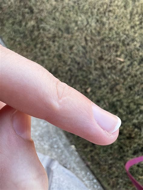 Any Idea On What This Circular Raised Lesion Could Be Ive Had It