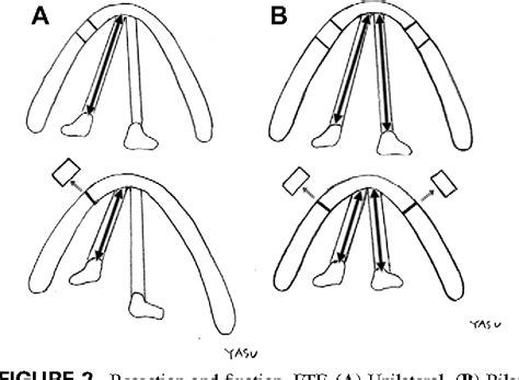 Table 2 From Type 3 Thyroplasty For Patients With Mutational Dysphonia Semantic Scholar