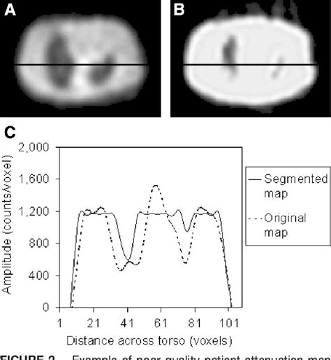Figure 1 From Problems Created In Attenuation Corrected Spect Images By Artifacts In Attenuation