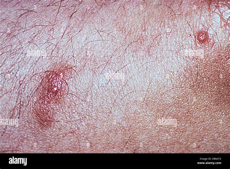 Pustules High Resolution Stock Photography And Images Alamy