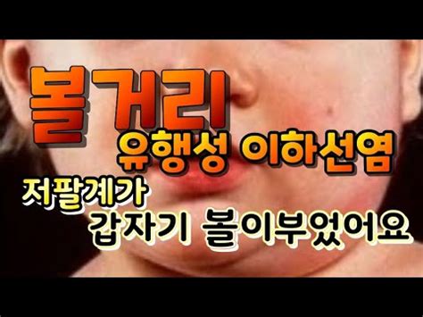 볼거리 유행성이하선염 갑자기 한쪽 볼이 부었어요 볼거리에 걸린 저팔계 어떻게 치료할까요 옮을까요 YouTube