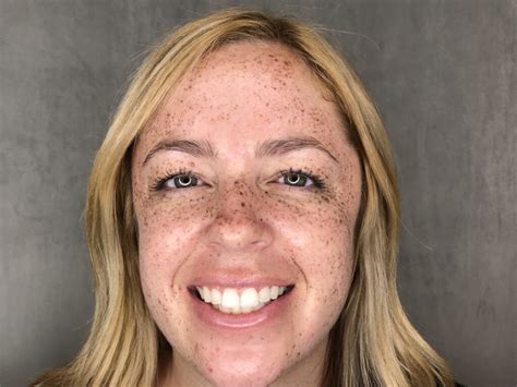 Bbl Hero And Moxi Medspa