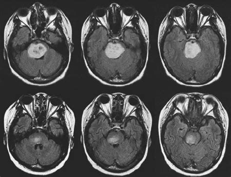 Axial FLAIR Images From A Year Old Girl With Diffuse Intrinsic Download Scientific Diagram