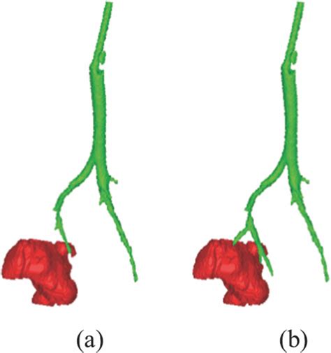 Airway Extraction Result A Without And B With Local Refinement