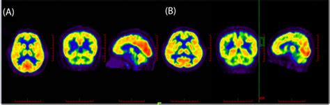 The ¹⁸f‐fluorodeoxyglucose ¹⁸f‐fdg Positron Emission Download Scientific Diagram