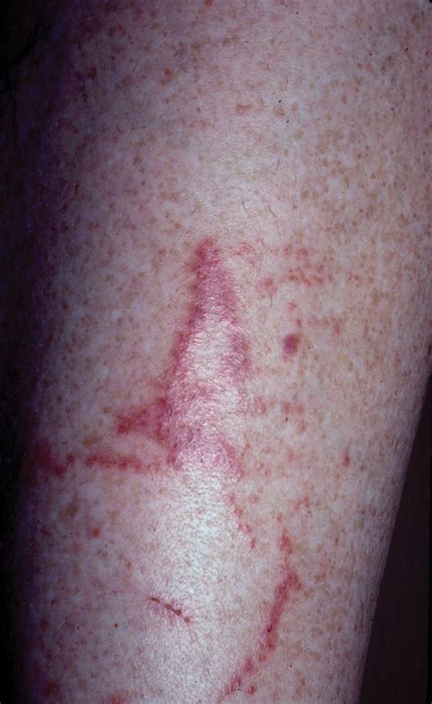 Aquatic Antagonists Jellyfish Stings Mdedge Dermatology