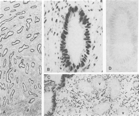 Pr In Late Proliferative Phase Endometrium Strong Immunostaining For Download Scientific