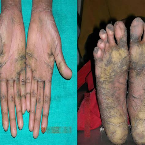 Orthopantomograph Showing Floating In Air Appearance Of Teeth