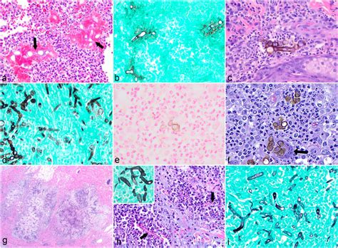Hyphae Pseudohyphae Yeasts Spherules Spores And More A Review On
